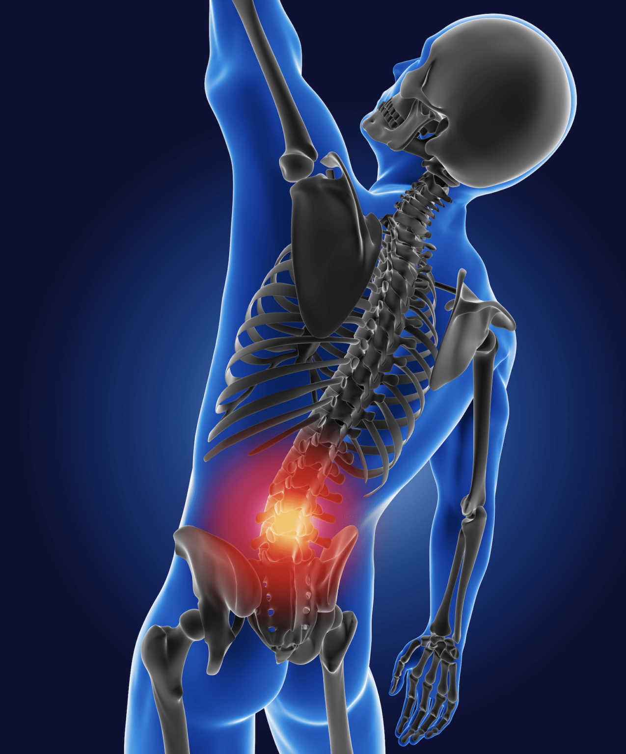 Discopatía Lumbar: causas, síntomas y tratamiento – Sportsalud Clínica ...